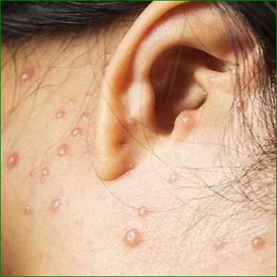 Kønsvorter hos mænd: Årsager, symptomer og behandling - januar 2026 ...